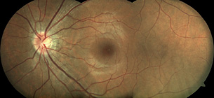 Retinal Images - Jones Vision Center